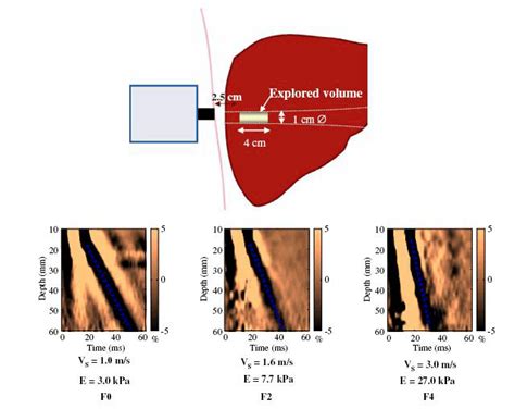 Racgp Fibroscan And Transient Elastography
