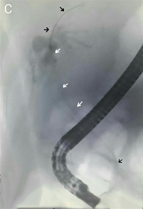 Ercp And Egd Migrated Biliary Stent