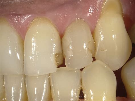 Re Treating Failed Anterior Direct Composite Restorations Inside Dentistry