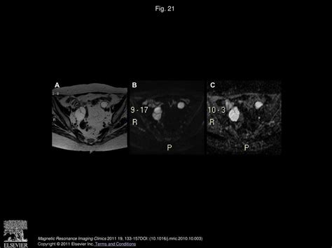 Pelvic Applications Of Diffusion Magnetic Resonance Images Ppt Download