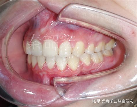 什么是正常的咬合 知乎