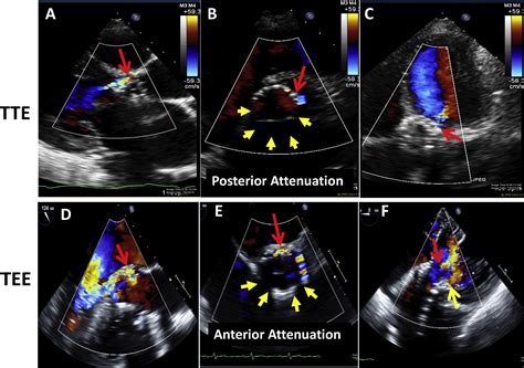 Guidelines For The Evaluation Of Valvular Regurgitation After Percutaneous Valve Repair Or
