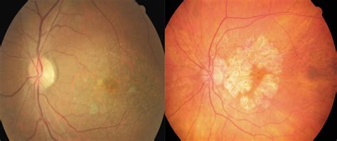 Geographic Atrophy Oct