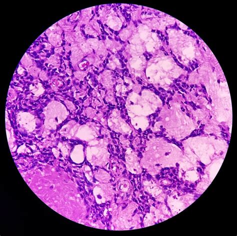 Managed Healthcare Executive On Linkedin Adaptimmune Completes Bla For