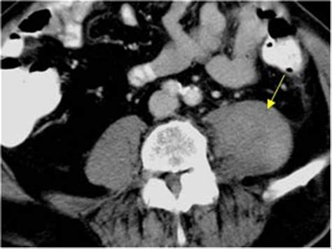 Abdomen And Retroperitoneum 1 9 Retroperitoneum And Great Vessels