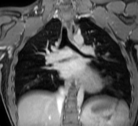 Chest Imaging Philips Mr Body Map