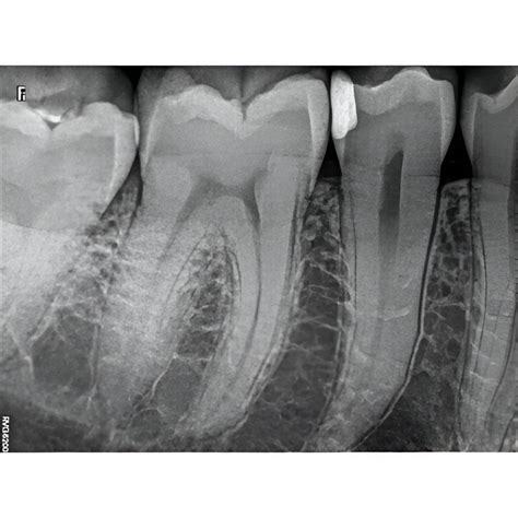Intraoral Sensor Global Imaging Usa
