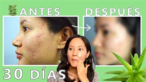 Tijeras Molesto Salida Aloe Vera Rostro Antes Y Despues Microordenador