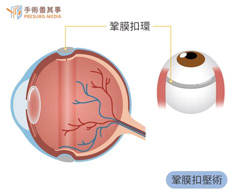 不痛不癢卻會瞎 沈默的視網膜剝離