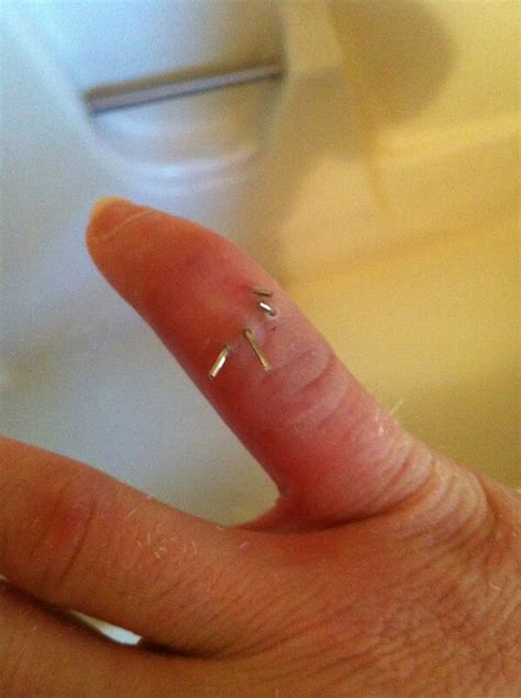 Broken Pinky Finger