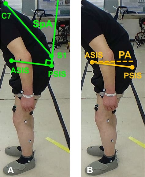 Measurement Of Dynamic Spino Pelvic Sagittal Balance During Gait From Download Scientific