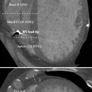 Assessment And Distribution Of RV Lead Positions RV Lead Positions Download Scientific Diagram