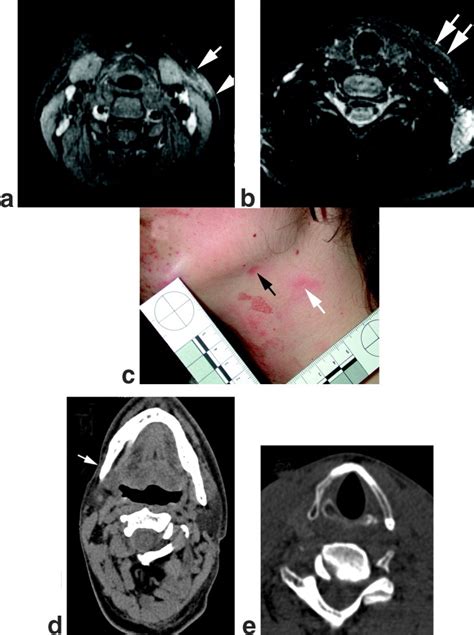 Strangulation Signs Initial Correlation Of Mri Msct And Forensic
