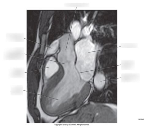 Mri Of The Left Ventricular Outflow Tract Diagram Quizlet