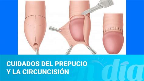 Cuidados del prepucio y la circuncisión YouTube