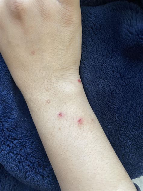 Bug Bite Scabs Scars R Bugbites