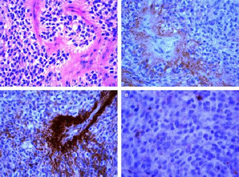 Photomicrographs Of A Clear Cell Ependymoma Showing Sheets Of Uniform