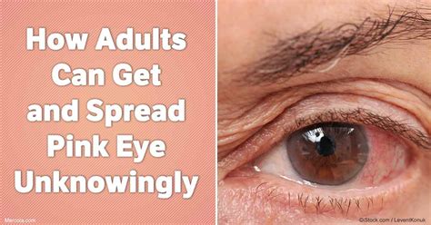 How Adults Can Get And Spread Pink Eye Unknowingly