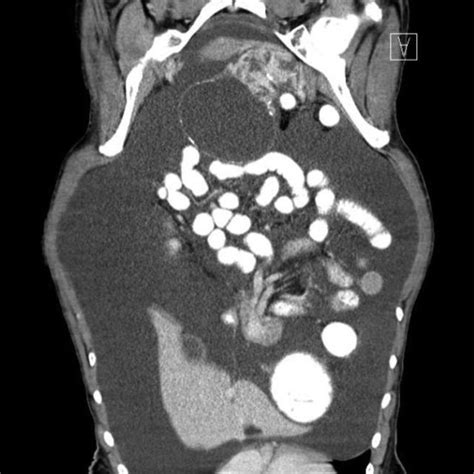 Inhomogeneous Diffuse Reduced Accumulation Of The Thyroid Gland