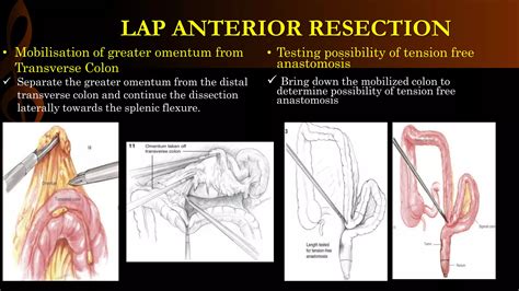 Lap Anterior Resection Step By Step Operative Surgery Pptx