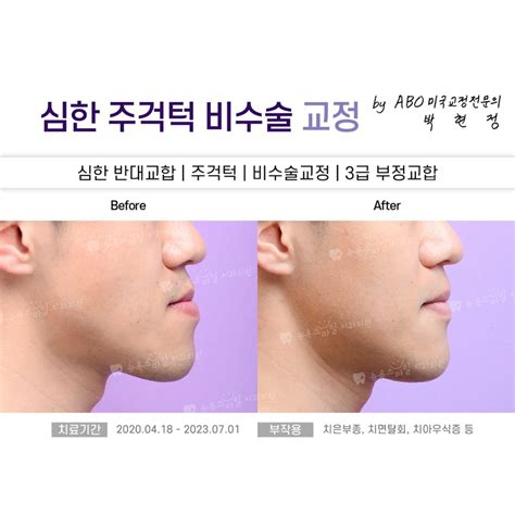 심한 주걱턱 비수술교정심한 반대교합주걱턱비수술교정3급부정교합 Beforeandafter 부산센텀해운대교정치과 뉴욕