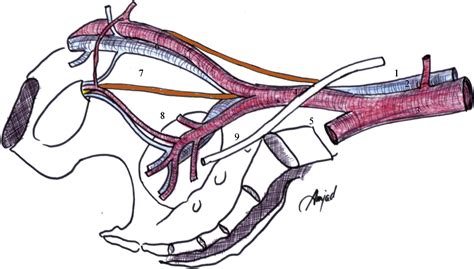 Optimizing The Approach For Lymph Node Dissection During Laparoscopic