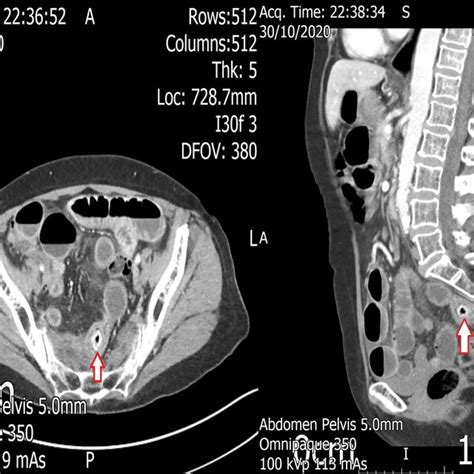 Axial And Sagittal CT Images Of The Patient With Evident Small Bowel Download Scientific