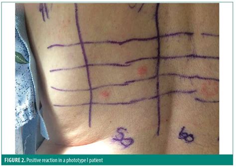 Comparison Of Patch Testing Results Of White And Black Patients Jcad