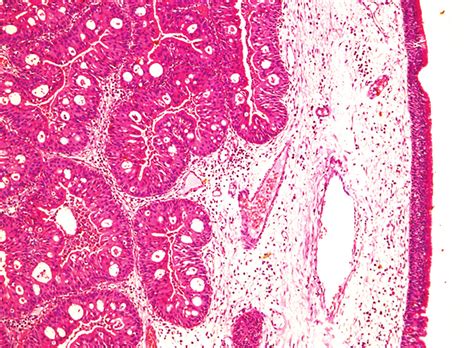 Ingrowth Of Respiratory Epithelium Into The Underlying Stoma As A
