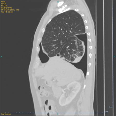 Pneumothorax Necessitans In A Patient With Trapped Lung And Rheumatoid