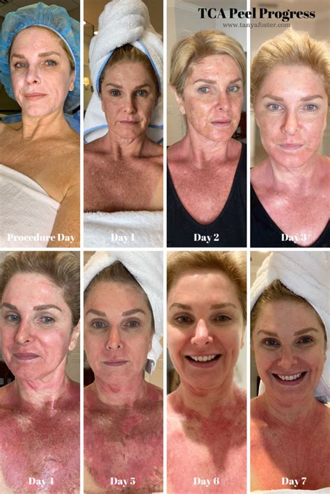 Truth Talk Should You Get A Tca Peel Tanya Foster