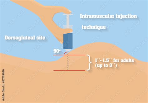 Angle Of Needle For Intramuscular Injection At Glen Robinson Blog