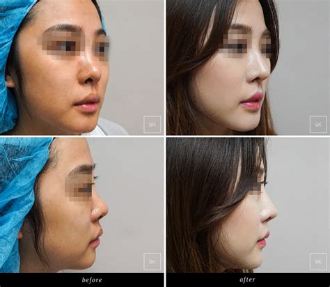 Before And After Nose Surgery Photos Sk Plastic Surgery