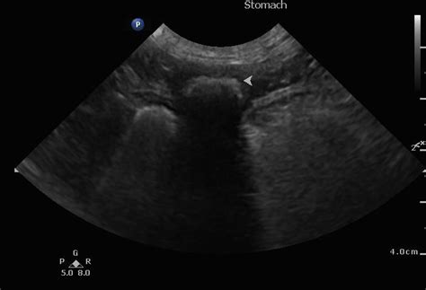 The Value Of A Negative Sonogram Members