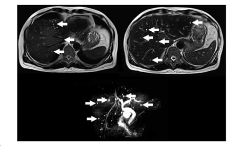 Liver Magnetic Resonance Imaging Mri And Magnetic Resonance