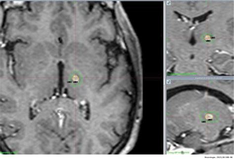 Gamma Knife® Stereotactic Radiosurgery As A Treatment For Essential And
