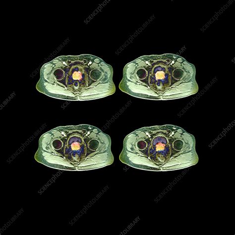 Prostate Cancer Mri Scans Stock Image M8650282 Science Photo