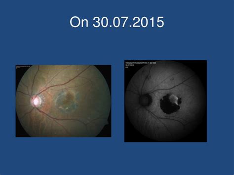 Ppt Rpe Tear Powerpoint Presentation Free Download Id 11697131