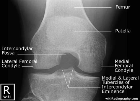 Radiographic Positioning Examples Of The Leg And Knee Ce4rt