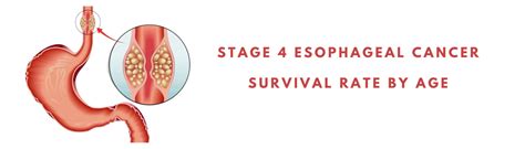 Squamous Cell Carcinoma Esophagus Survival Rate