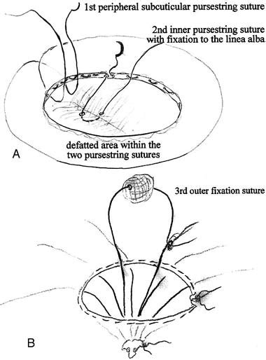 Immediate Navel Reconstruction After Total Excision A Simple Three Suture Technique Surgery