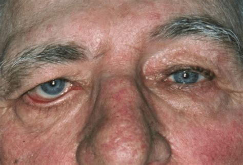 Brow Ptosis Ento Key