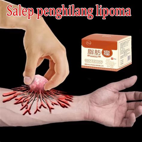 Jual Lipoma Cream Benjolan Salep Benjolan Obat Benjolan Lipoma Benjolan Di Seluruh Tubuh