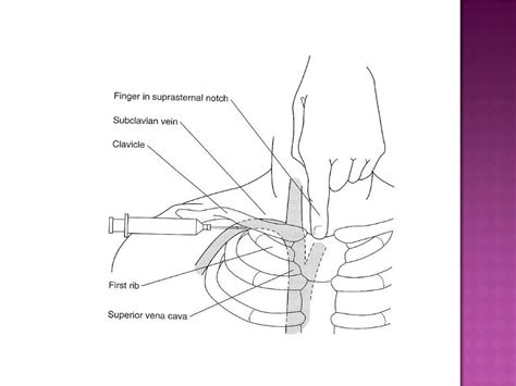 Central Venous Catheterization Ppt