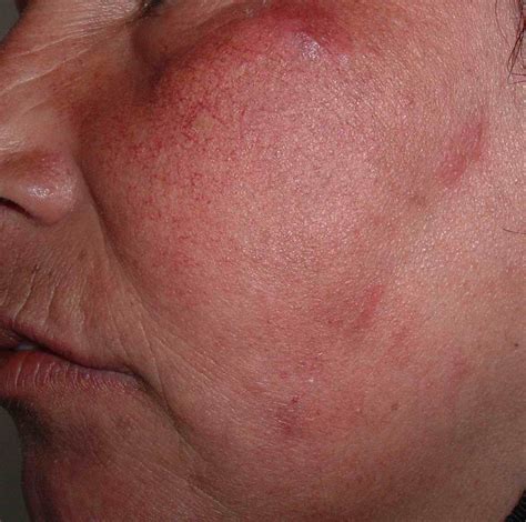 Persistent Facial Erythema Red Face Dermatology Games