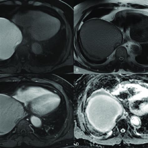A D T1 Weighted Thoracic Mri T2 Weighted Thoracic Mri T1 Weighted