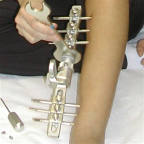 A Unilateral External Fixator During The Lengthening Process In The Tibia Download Scientific