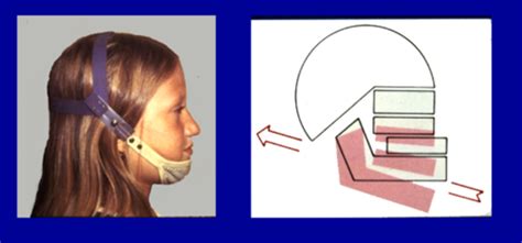 Class Iii Malocclusion Flashcards Quizlet