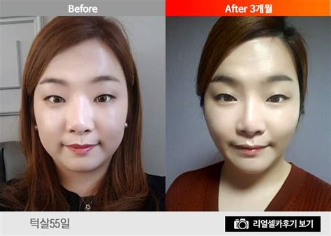 차이정성형외과 하악골 측면부위의 피하지방을 3차원적으로 제거하여 주변의 피부와 처진살이 바로 Facebook