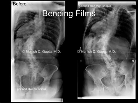 Adult Idiopathic Scoliosis Munish C Gupta Md